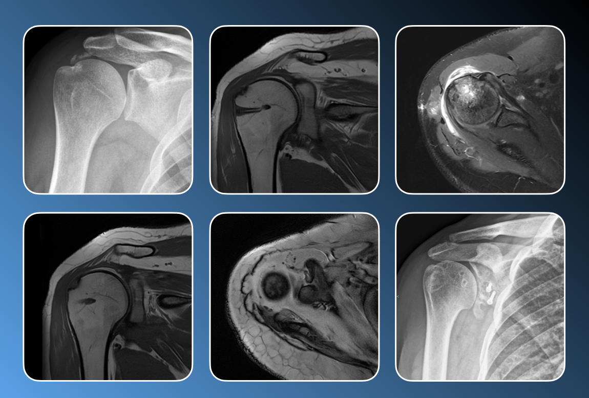 Imaging of the Post-Operative Shoulder | BerlinCaseViewer by ...