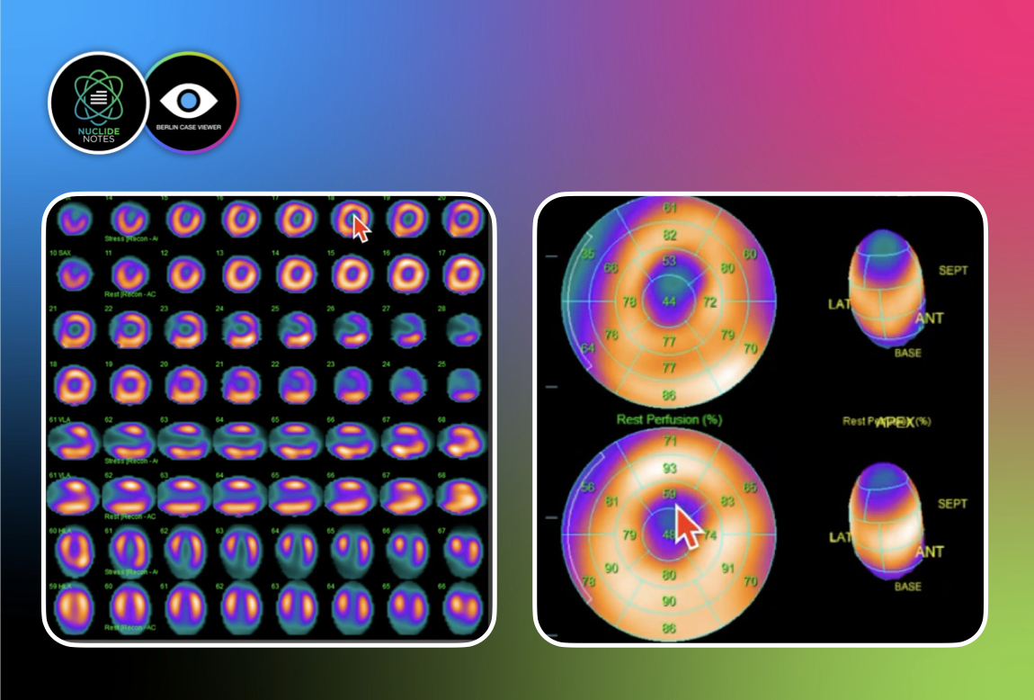 Cracking the Code: Perfusion Defects in SPECT MPI Explained ...